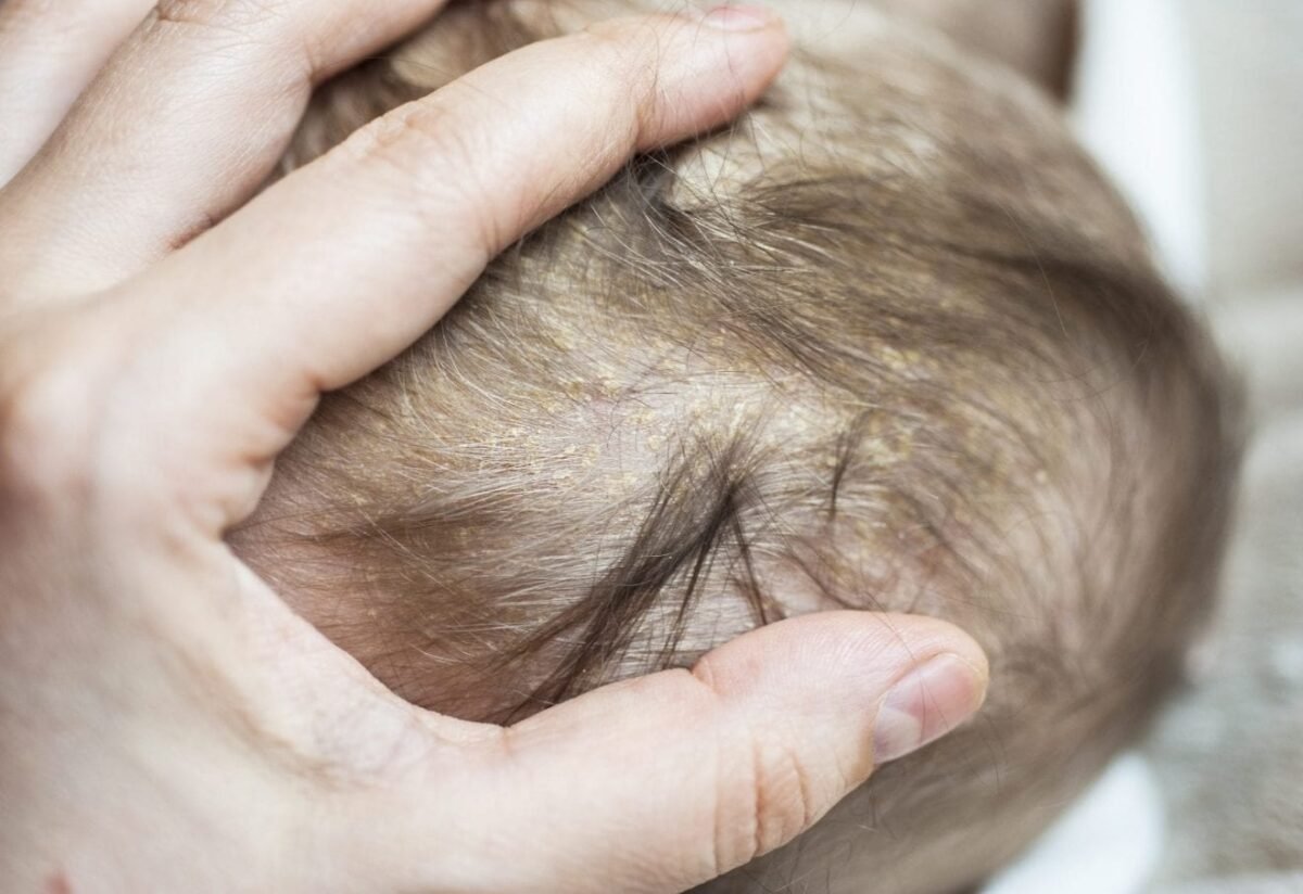 Seborrheic dermatitis in babies: 10 ways to treat cradle cap – Healthtost